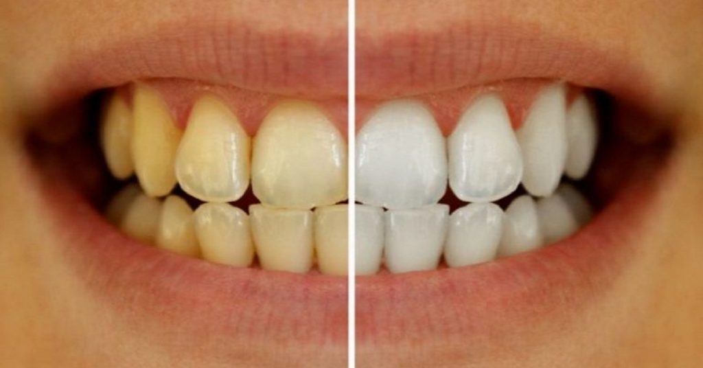 Essa maravilhosa mistura simples e barata deixará seus dentes limpos e ...