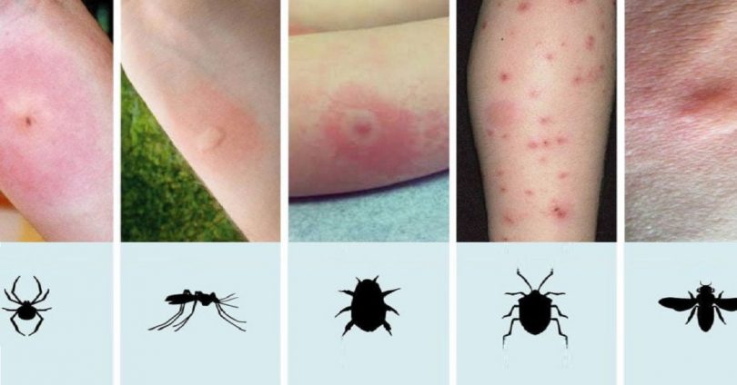 8 Picadas de insetos que você deve saber diferenciar para evitar que o ...