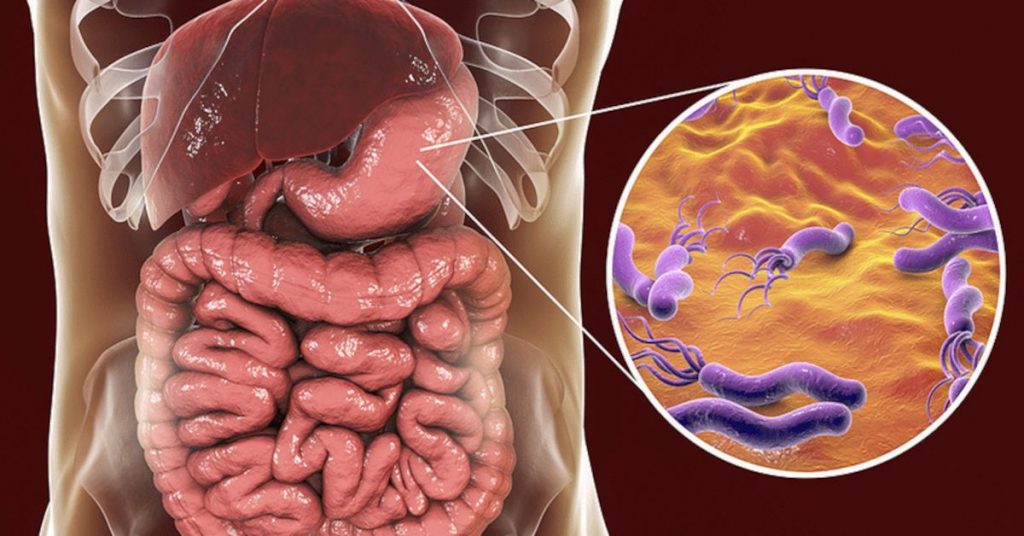 Helicobacter Pylori: O que é, sintomas e tratamentos, você precisa ...
