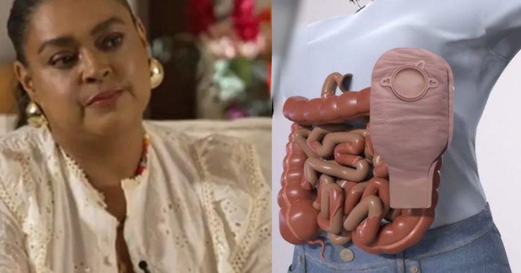 O que é amputação do reto? Entenda o procedimento cirúrgico enfrentado ...